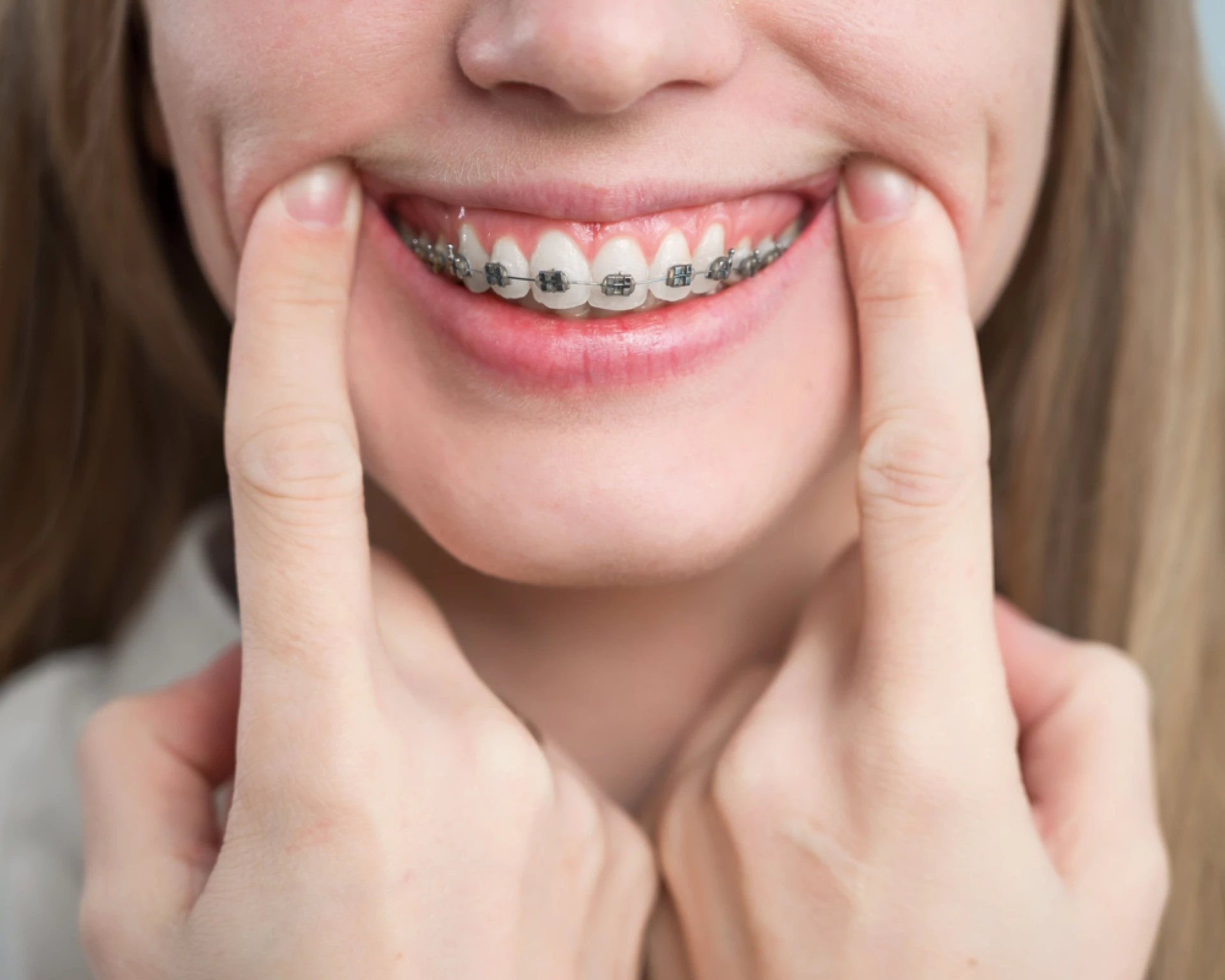 Aparat Dentar Metalic - Neoclinique București Aparat Dentar Metalic - Neoclinique București